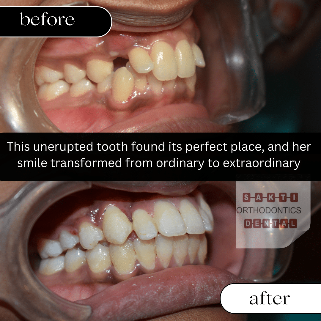 Unlocking Smiles: How Braces Help Impacted Upper Canines Find Their Way ...